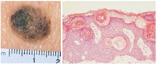 PUBLIC HEALTH: SEBORRHEIC KERATOSIS and EPIDERMAL NEVUS