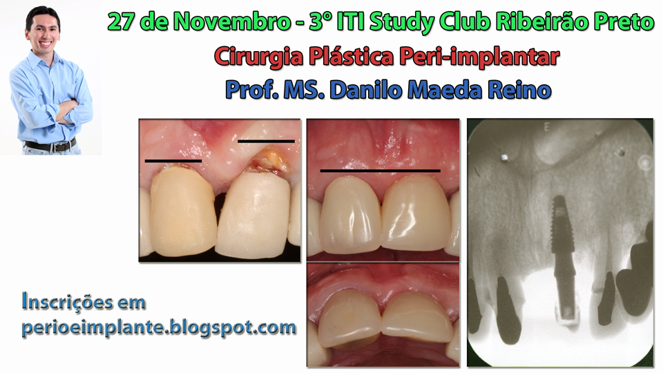 Periodontia e Implantes: 3° ITI Study Club Ribeirão Preto - Estética ...