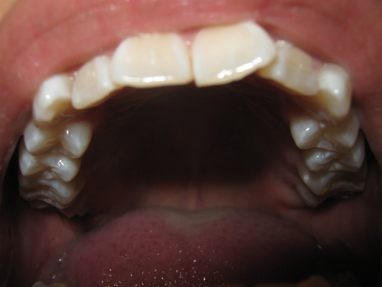 Br@ndy's Invisalign Journey: Tray 10