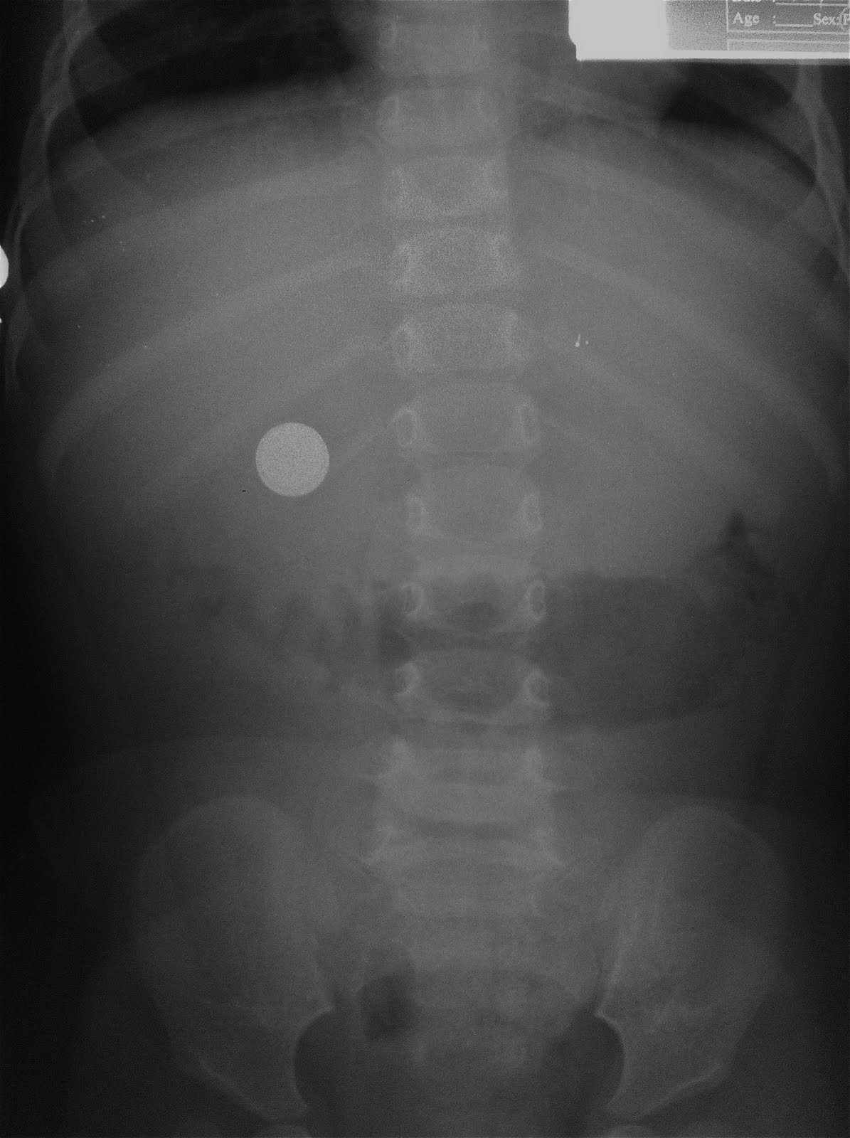 MedView Medical Imaging Consultancy Info Page: Ingested button cell