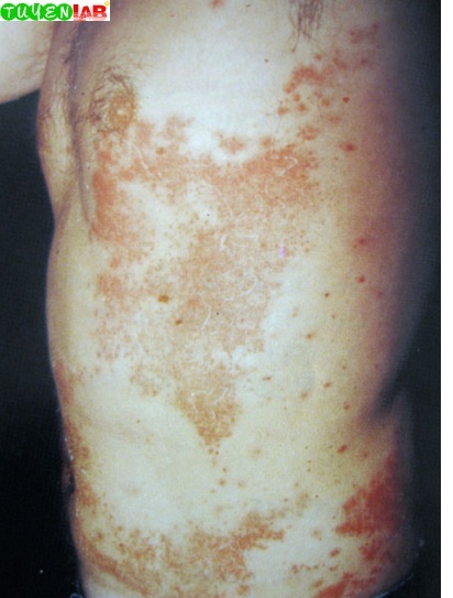 [Dermatology] Atlas of Contact Dermatitis | Free Medical Atlas