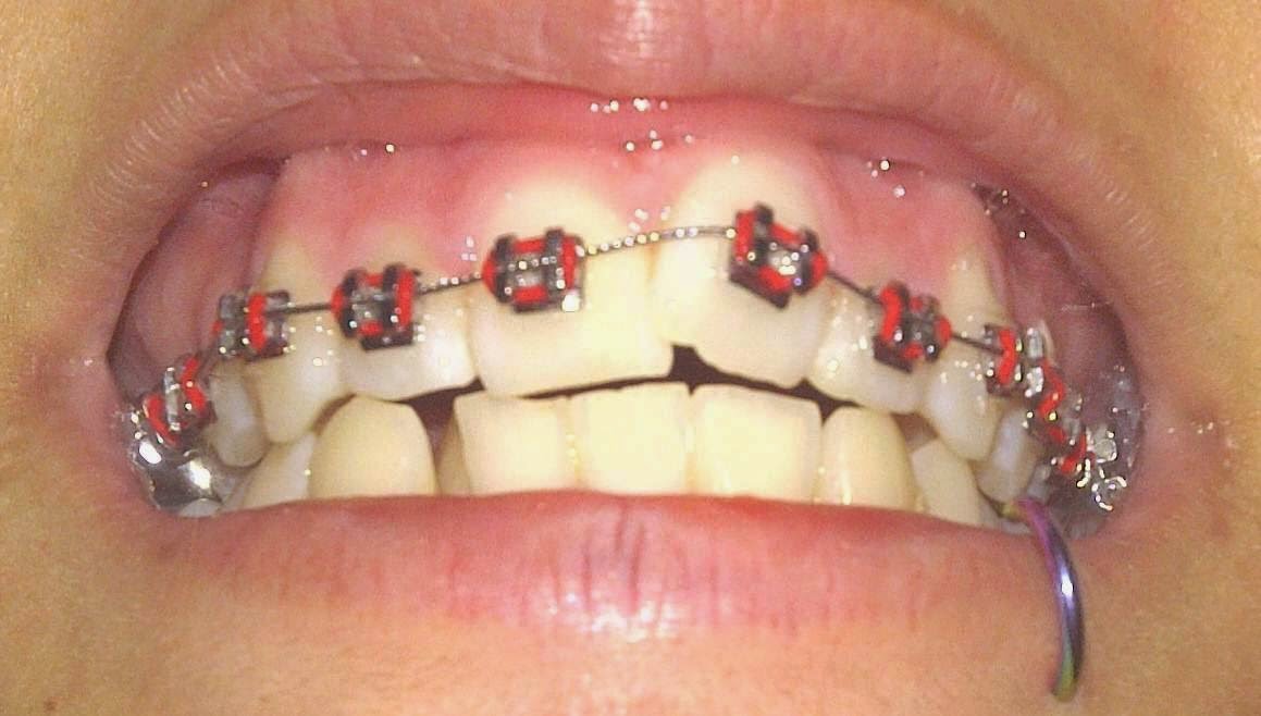 Mis Brackets: Paso a Paso [Mi experiencia]: 13/Marzo/2014 - CAMBIO DE LIGAS