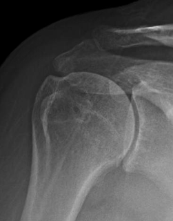 UW Shoulder and Elbow Academy: The axillary - truth - view. It tells us ...
