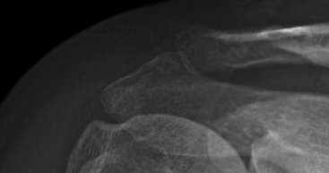 UW Shoulder and Elbow Academy: The axillary - truth - view. It tells us ...