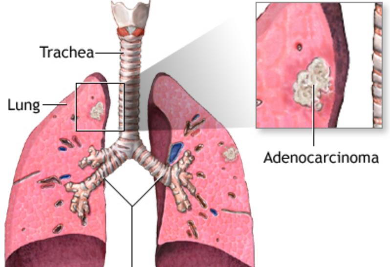 Stage 2a Lung Cancer Life Expectancy Cancerwalls