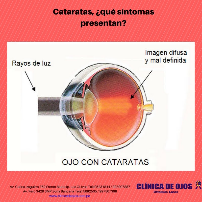 Clínica de Ojos Oftalmic Láser: Cataratas, ¿qué síntomas presentan?