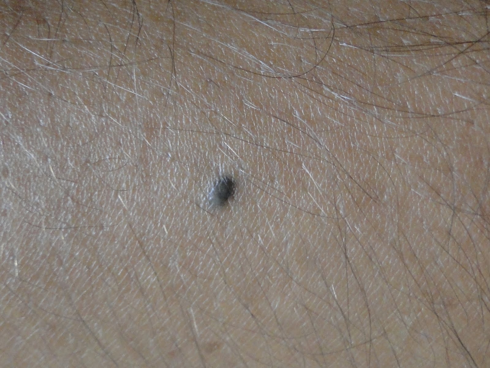 Nevo Azul Pode Virar Câncer - RETOEDU