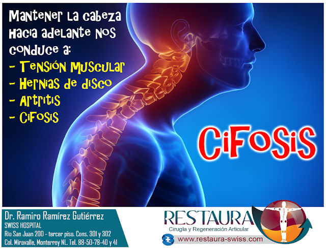 DrColumna: CIFOSIS