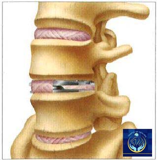 Affordable Lumbar Disc Microsurgery in India: International Patient ...