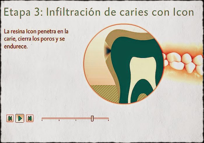 RESINAS ICON: ¿Nueva cura de Caries Dental? Sin anestesia y sin taladro ...