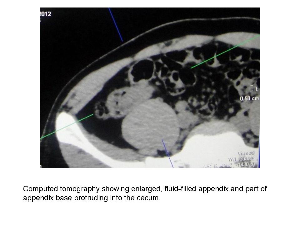 BÀI SOẠN VỀ SIÊU ÂM CHẨN ĐOÁN: NHÂN CA LỒNG RUỘT RUỘT THỪA tại MEDIC