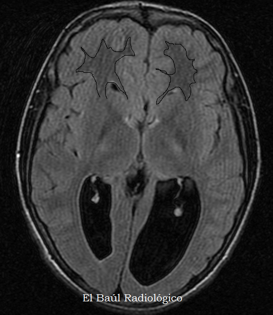 El Baúl Radiológico: AGENESIA DEL CUERPO CALLOSO: HALLAZGOS EN TC e IRM ...
