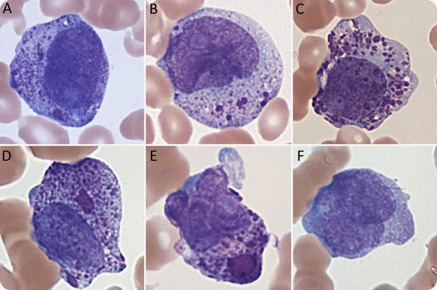 Medical Laboratory and Biomedical Science: Chediak-Higashi–like ...
