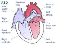 KESEHATAN IBU & ANAK: Atrial Septal Defect (ASD)