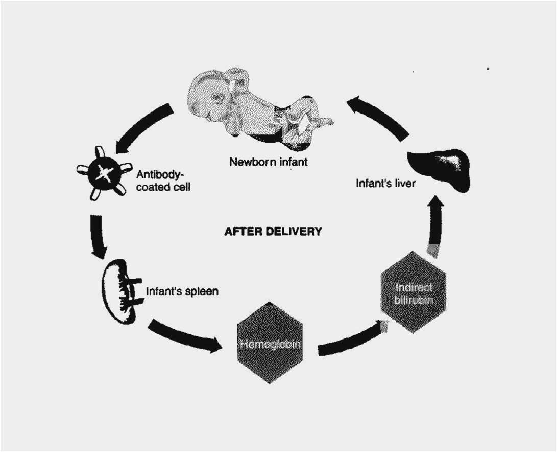 Haemolytic Disease of the Newborn (HDN): Pathogenesis
