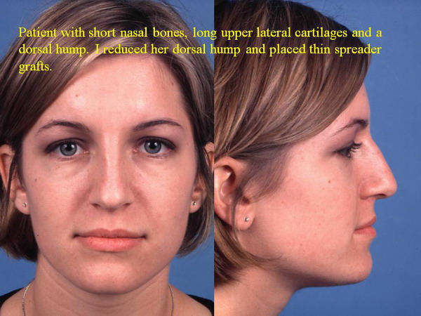 Dr. Dean Toriumi Reviews: Can Dr. Toriumi work with big and wide noses?