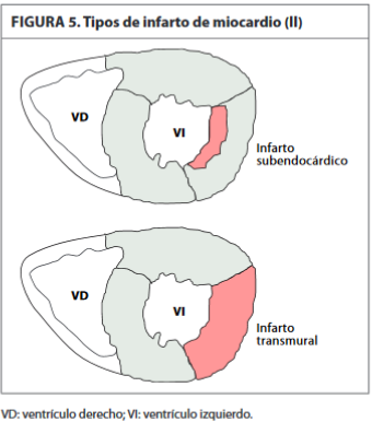 Cardiopatia Isquemica : INFARTO AGUDO DE MIOCARDIO
