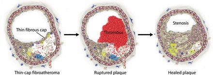 EmergenMed Health Blog: Síndromes coronarios agudos