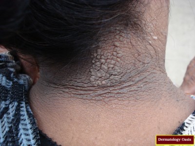 What Is Acanthosis Nigricans? - Teroes