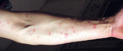 Doenças BR: Pitiríase Rósea - Fotos, Sintomas e Tratamento - GUIA ...