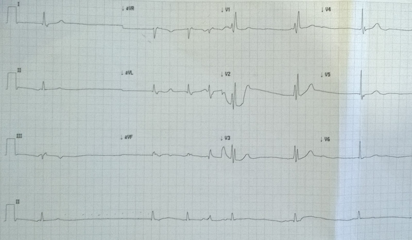 Cardiology window: Severe sinus node dysfunction in Old age male