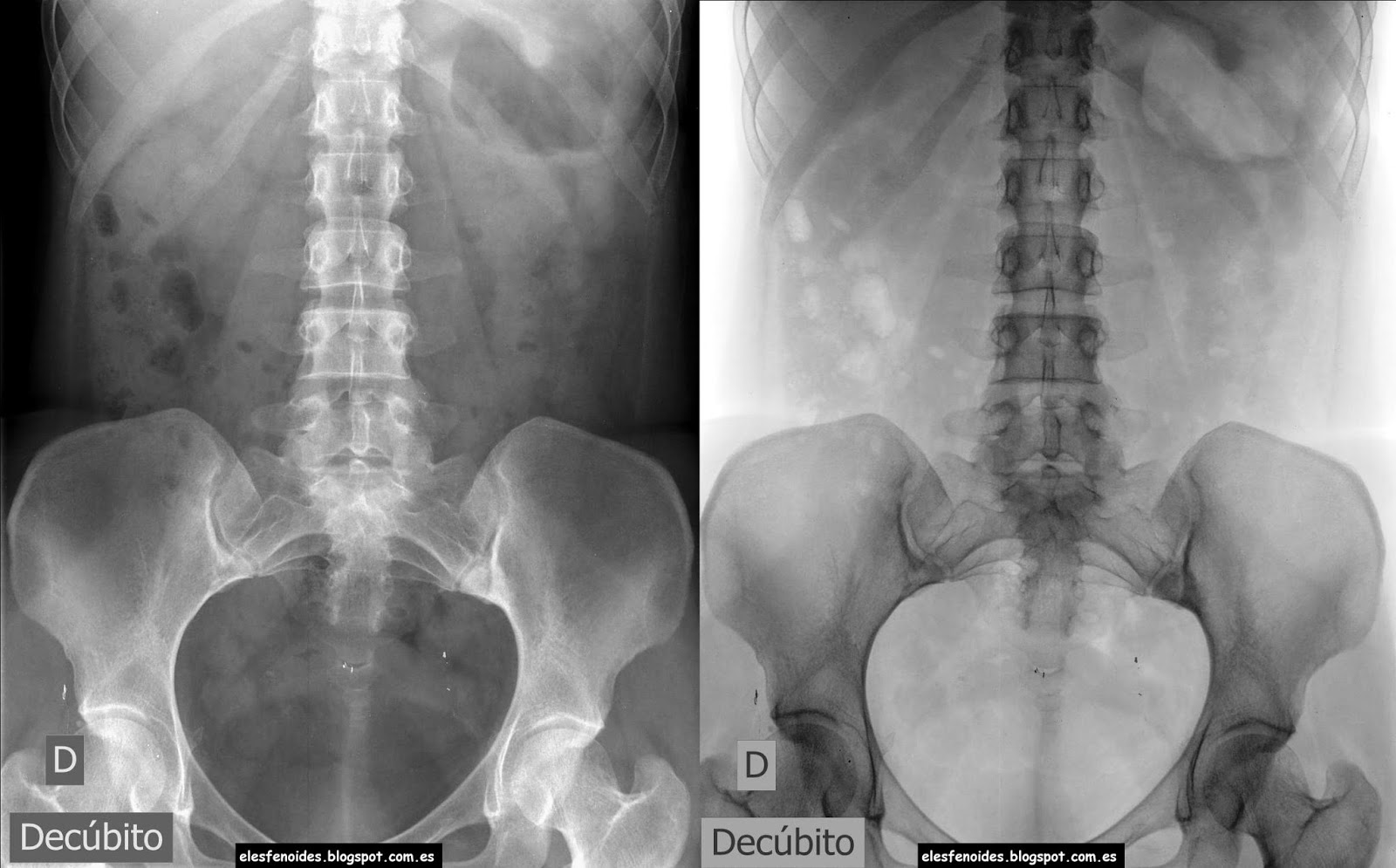 El esfenoides: Osteítis condensante ilíaca. 2 imágenes 1 caso.