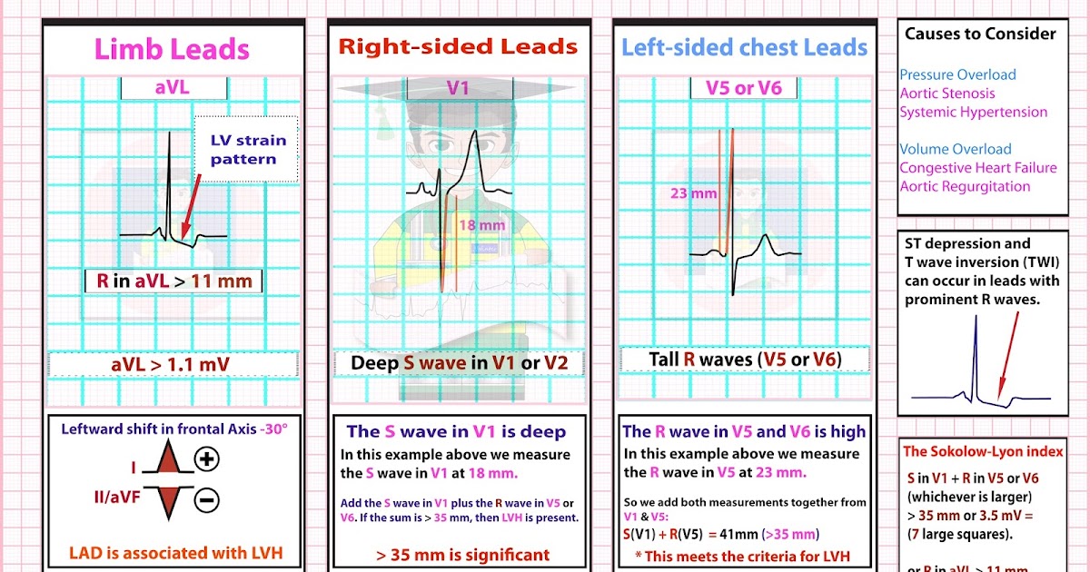 ECG Educator Blog : LVH by voltage criteria - (Sokolow-Lyon Index)
