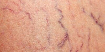 MedFriendly Medical Blog: Spider Veins vs. Varicose Veins - What's the ...