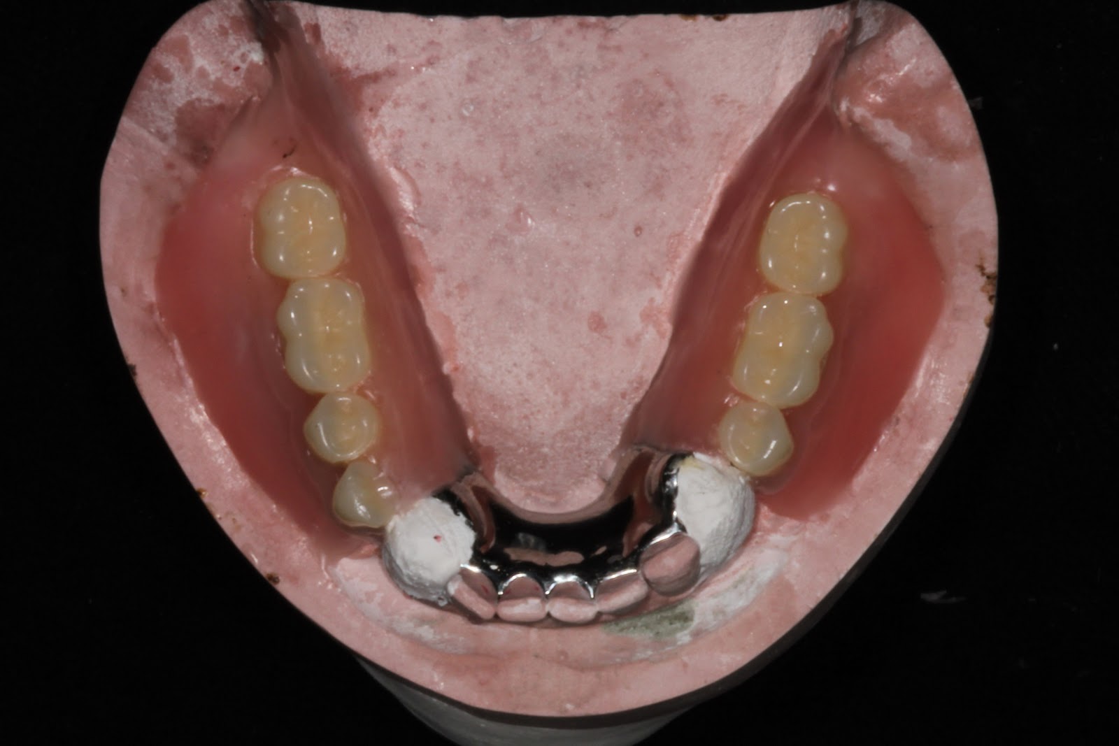 Boise Idaho Prosthodontics: Semi-Precision attachment RPD - 3 different ...