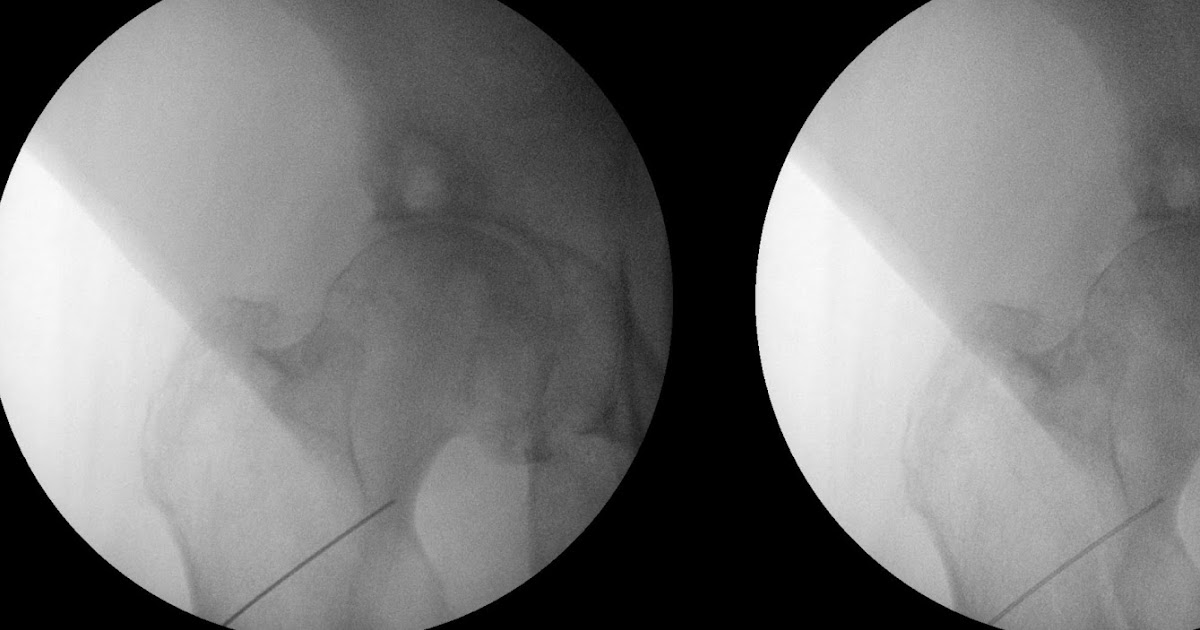 Interesting Topics in Orthopedic Surgery by Dr. Nasar: Hip Air ...