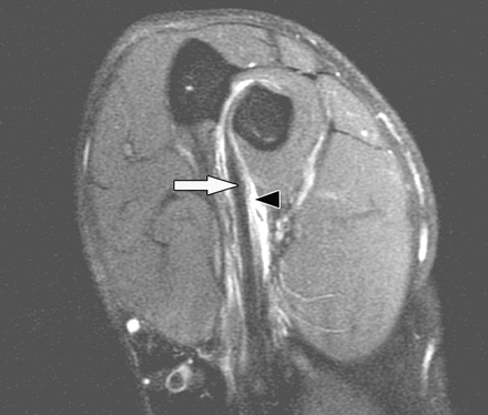 MRI Musculo-Skeletal Section: Biceps injury