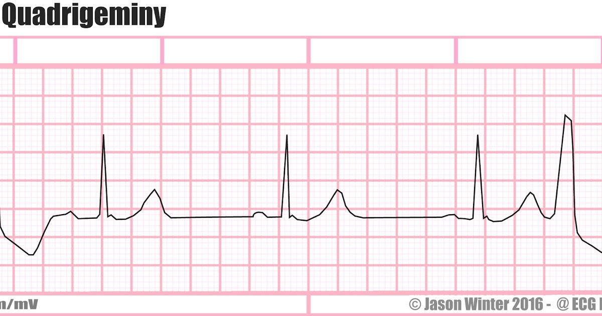 ECG Educator Blog : Ventricular Quadrigeminy