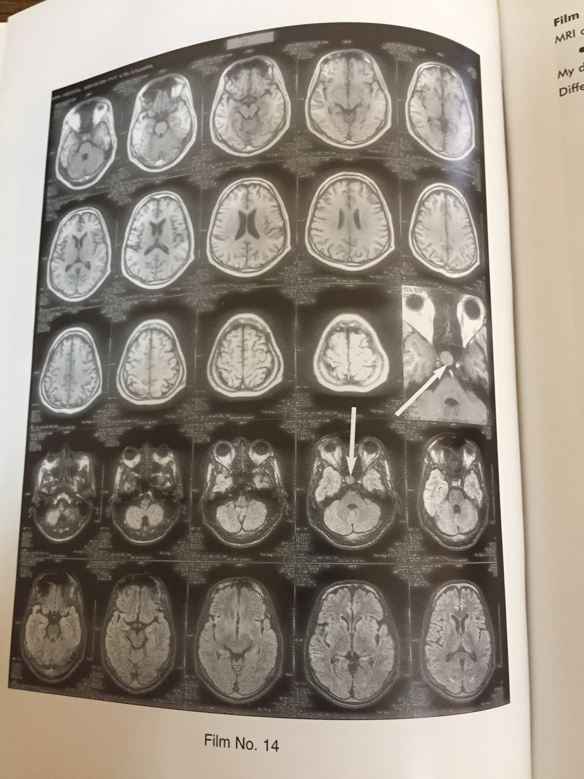 CT SCAN OF BRAIN-7