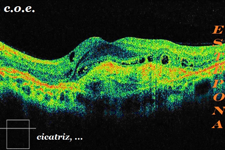 DEGENERACION MACULAR : OCT: PLUS DE EFICIENCIA