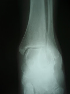 Podo Basas al Día: Yatrogenia traumatológica. Edema maleolar ...