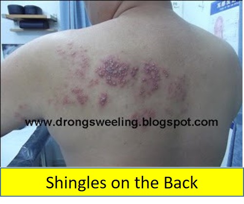TCM News: Where do shingles appears in our body?