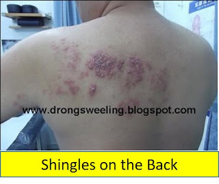 TCM News: Where do shingles appears in our body?