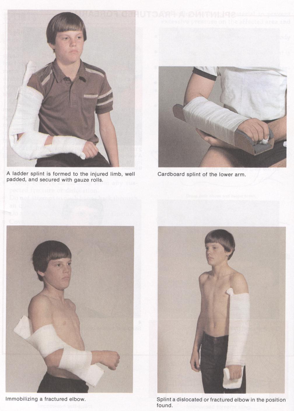 H. Triyo Rachmadi, S.Kep., M.H (Kes).: PEMBIDAIAN/ SPALK (Oleh: Triyo ...