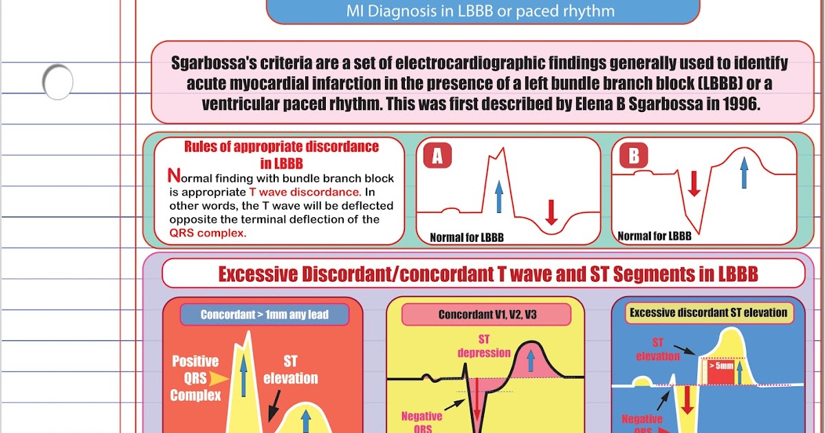 ECG Educator Blog : Sgarbossa criteria