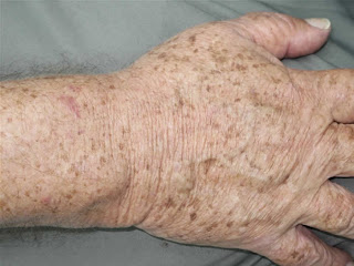 Dr. Renato Palhares: Melanose solar "mancha senil"