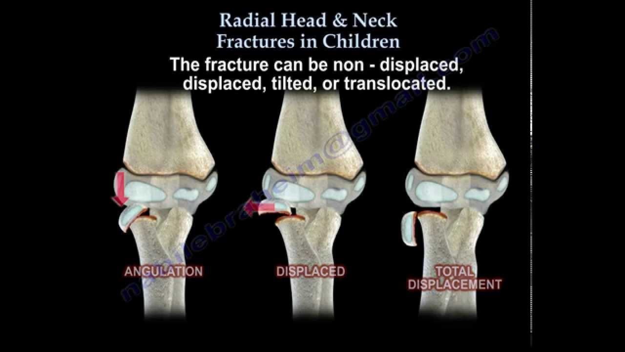 Child bone fracture