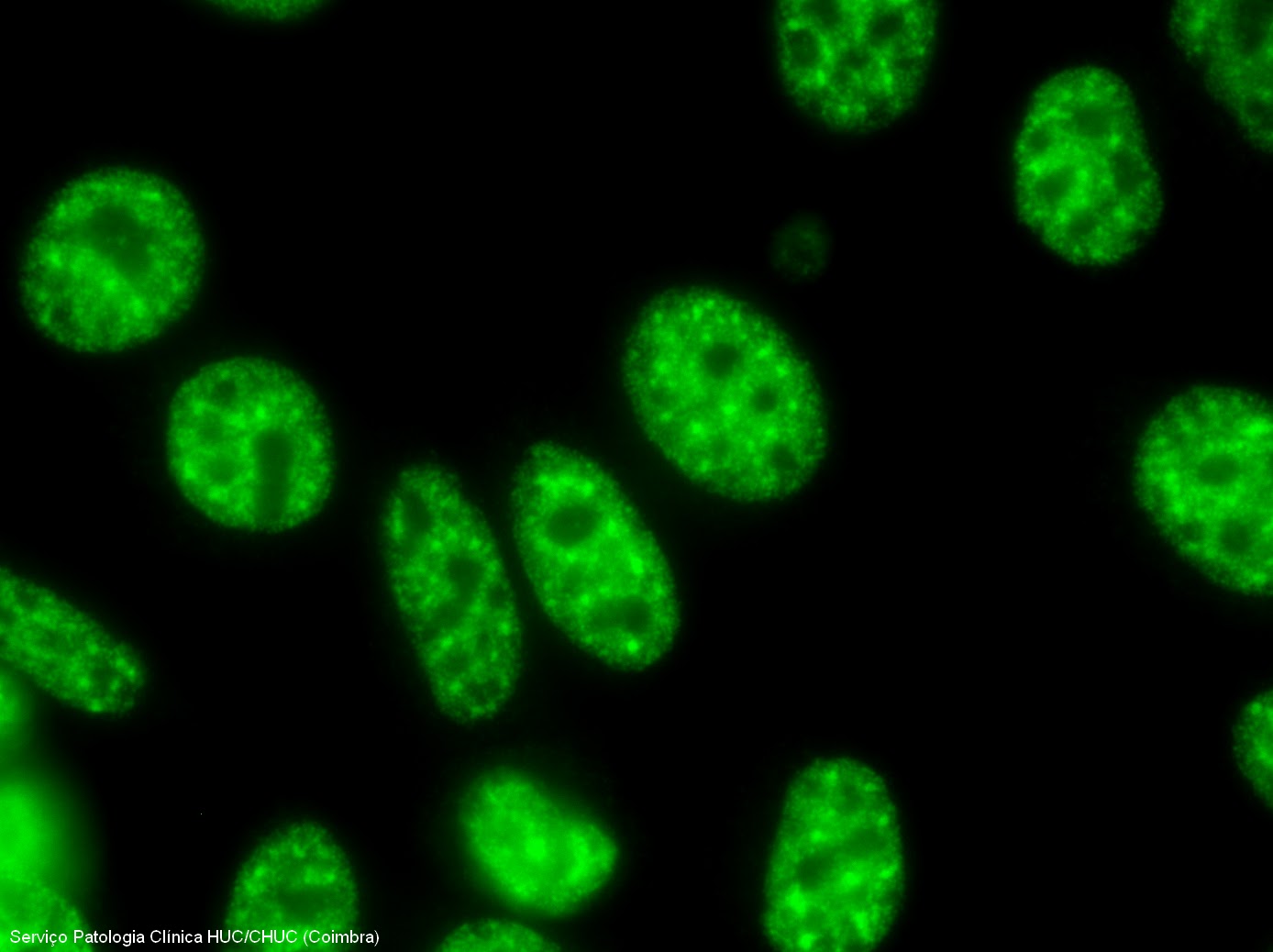 Anticorpos anti - Sm e anti - RNP