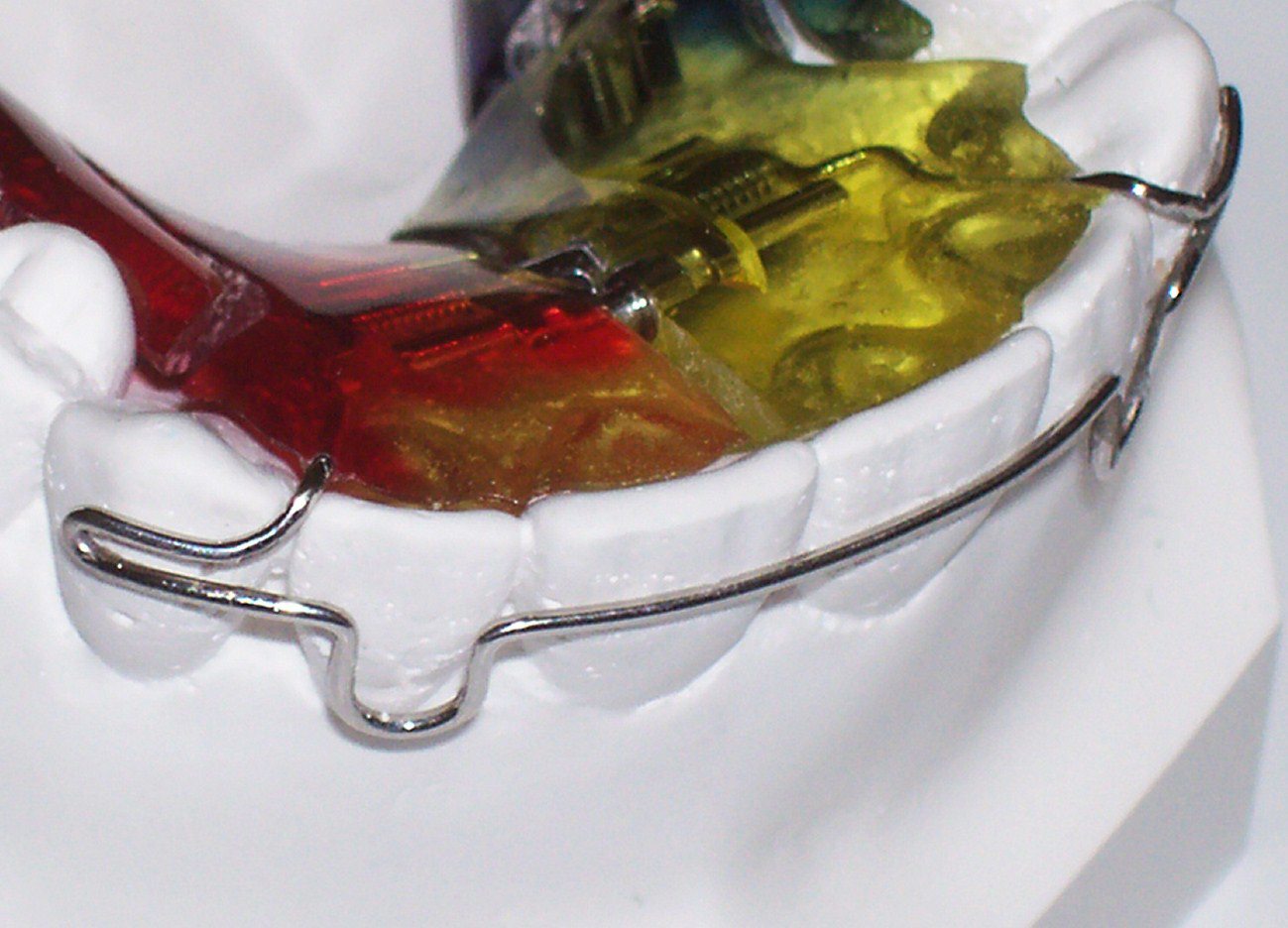 Вестибуларни дъги ~ Медико-техническа ортодонтска лаборатория "Ortho Lab"