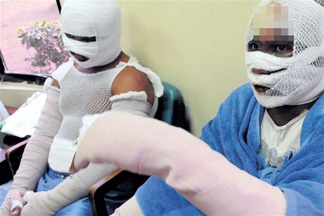 Laversióndigital.com: Tratamiento de quemados supera los RD$40,000 al día