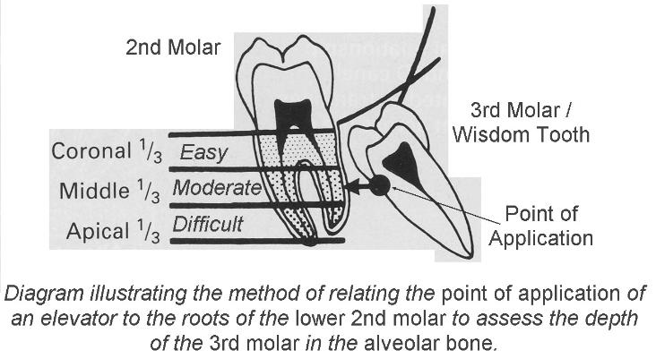 Dentistry and Medicine: Impacted Mandibular 3rd Molar Classification ...