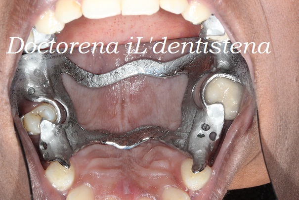 My Dental Diary: CO-Cr. RPD