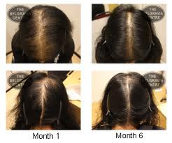 Make Over: Polycystic Ovary Syndrome (PCOS) - main reason for Hair Loss