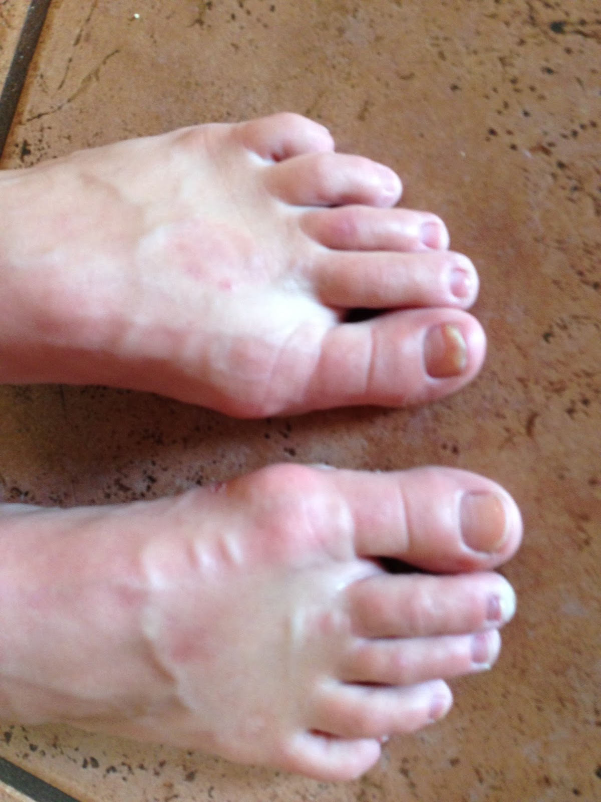 Running Shoes and Bugaboo's: Gnarly toes!