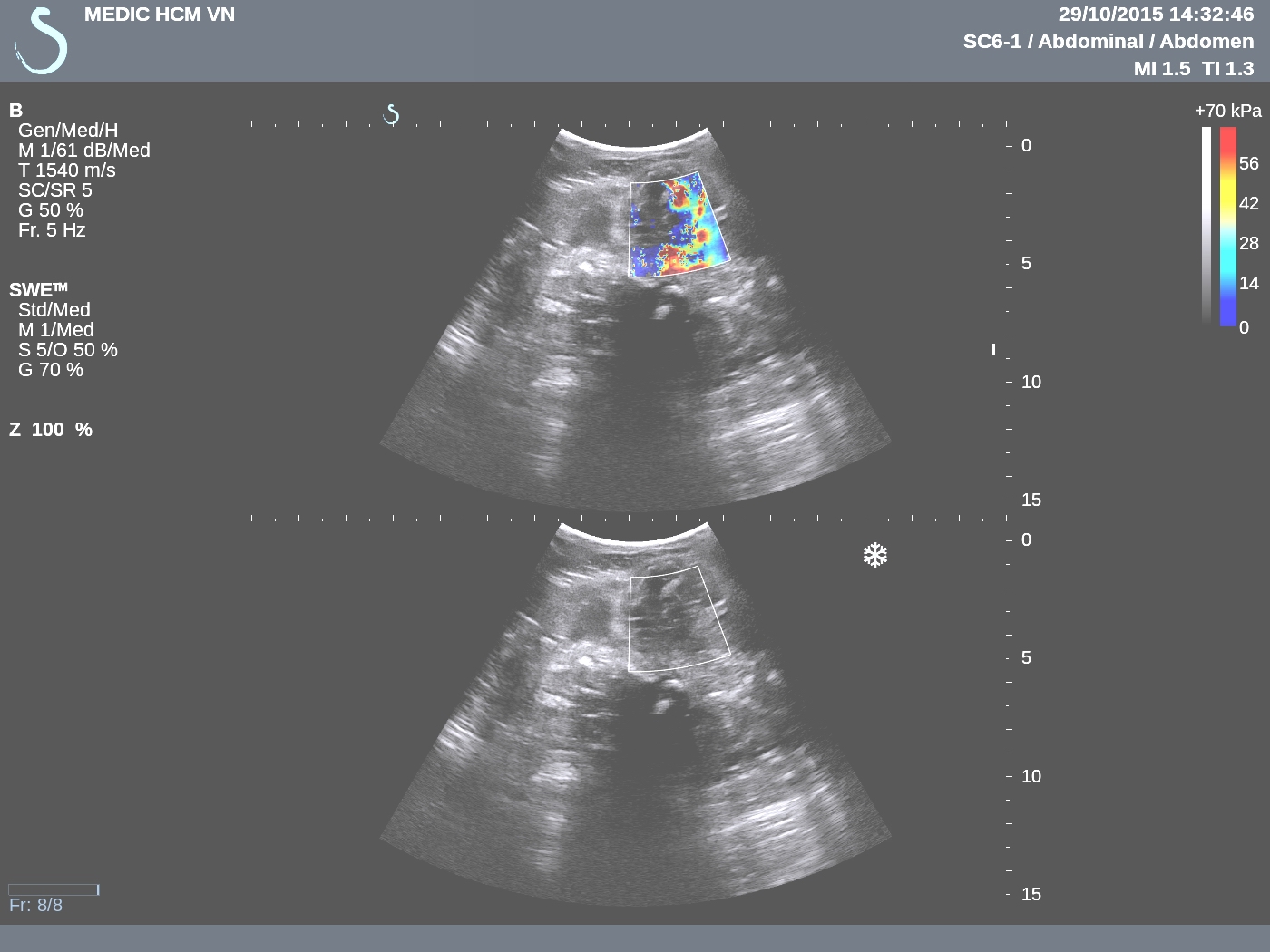 VIETNAMESE MEDIC ULTRASOUND: CASE 344 :LEFT GROIN TUMOR, Dr PHAN THANH ...