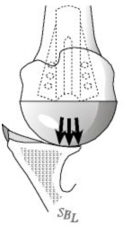 UW Shoulder and Elbow Academy: Ream and Run for Shoulder Arthritis - is ...